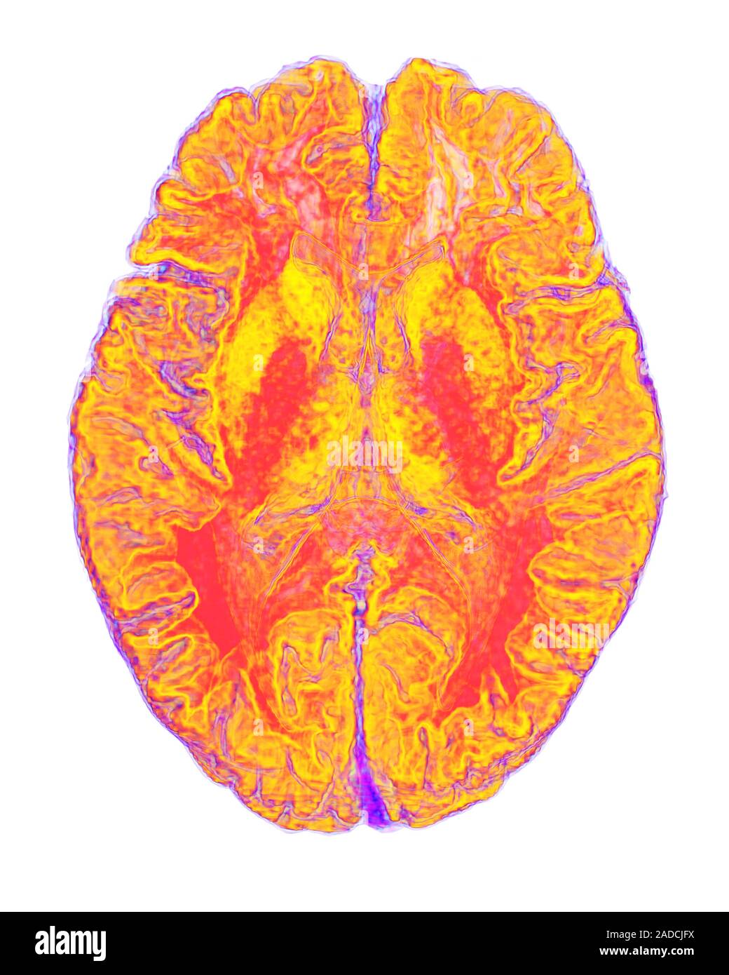 Human brain. Coloured axial magnetic resonance imaging (MRI) scan through a normal human brain ...