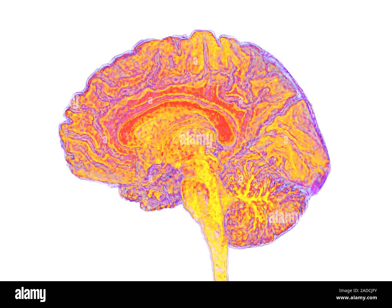 Human brain. Coloured sagittal magnetic resonance imaging (MRI) scan ...