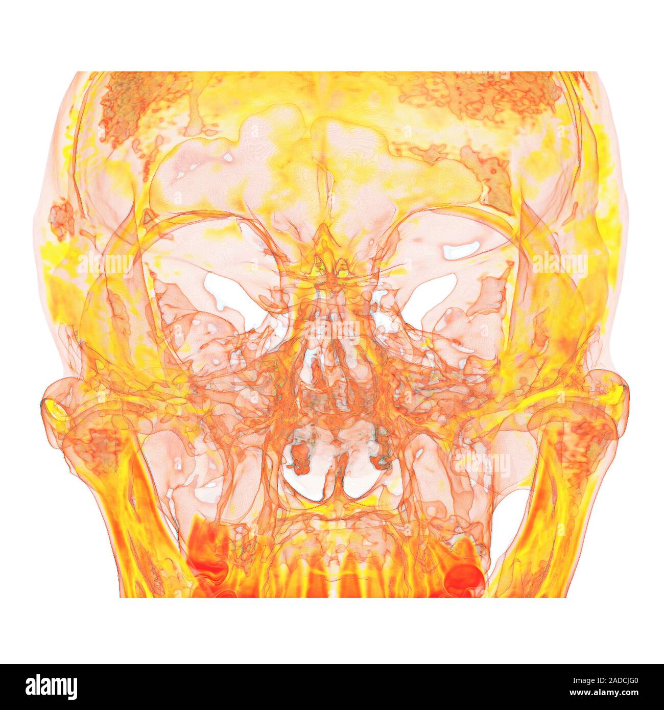 Facial bones of the skull. Coloured frontal 3D computed tomography (CT ...