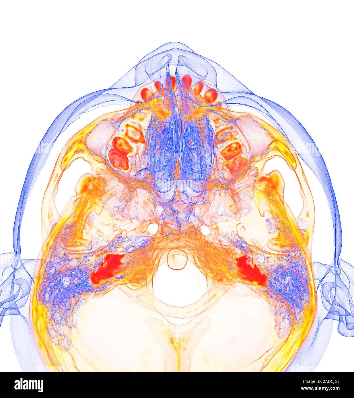 Base of the skull and head. Coloured 3D computed tomography (CT) scan ...