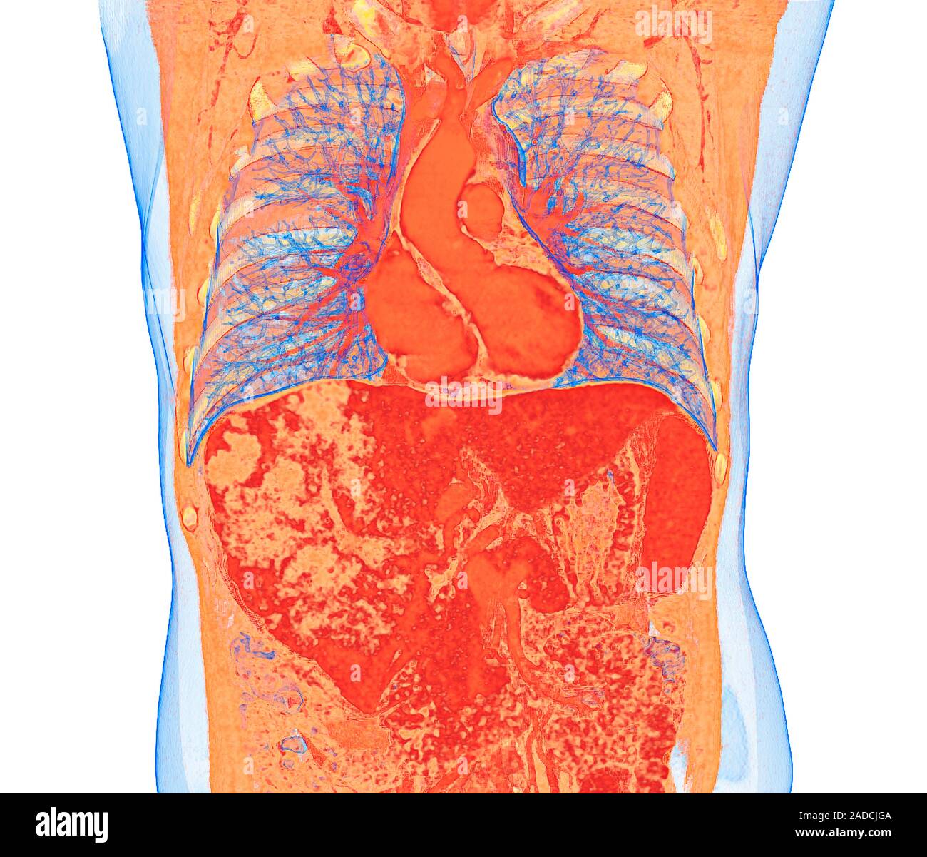 Liver cancer. Coloured coronal computed tomography (CT) scan through the chest and abdomen of a ...