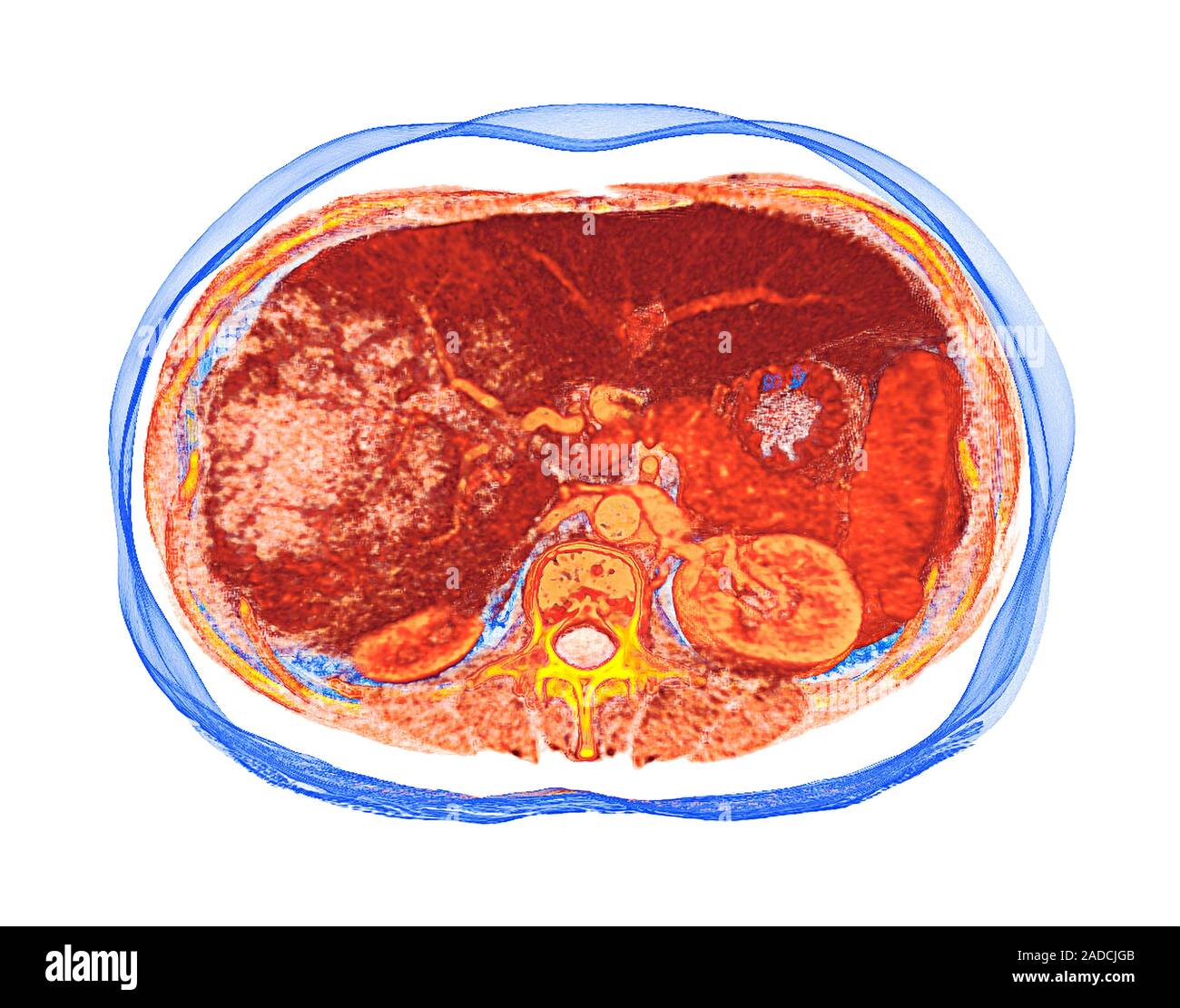 Liver cancer. Coloured axial computed tomography (CT) scan through the ... Liver cancer. Coloured axial computed tomography (CT) scan through the ...