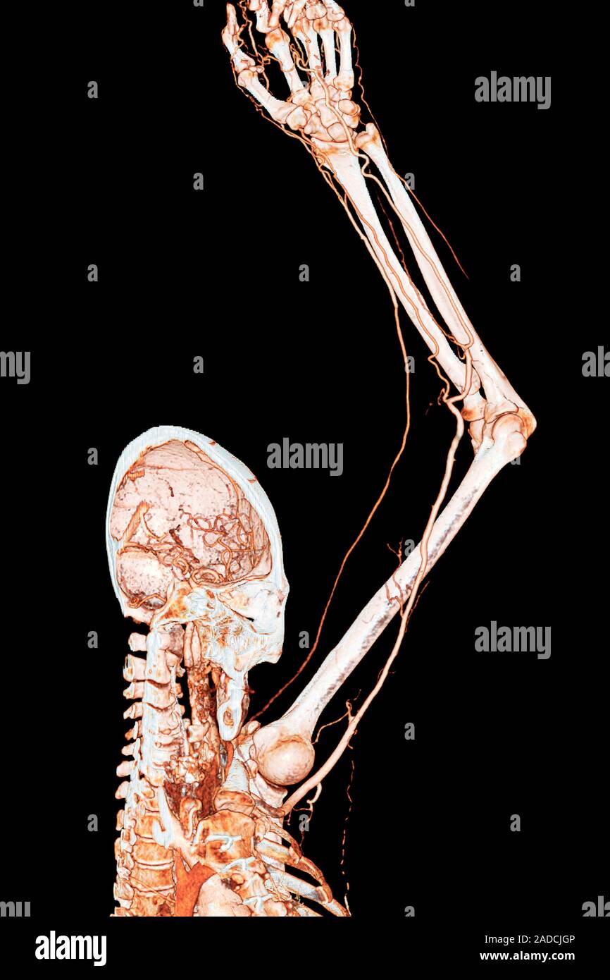Head, shoulder and arm arteries. Coloured 3D computed tomography (CT ...