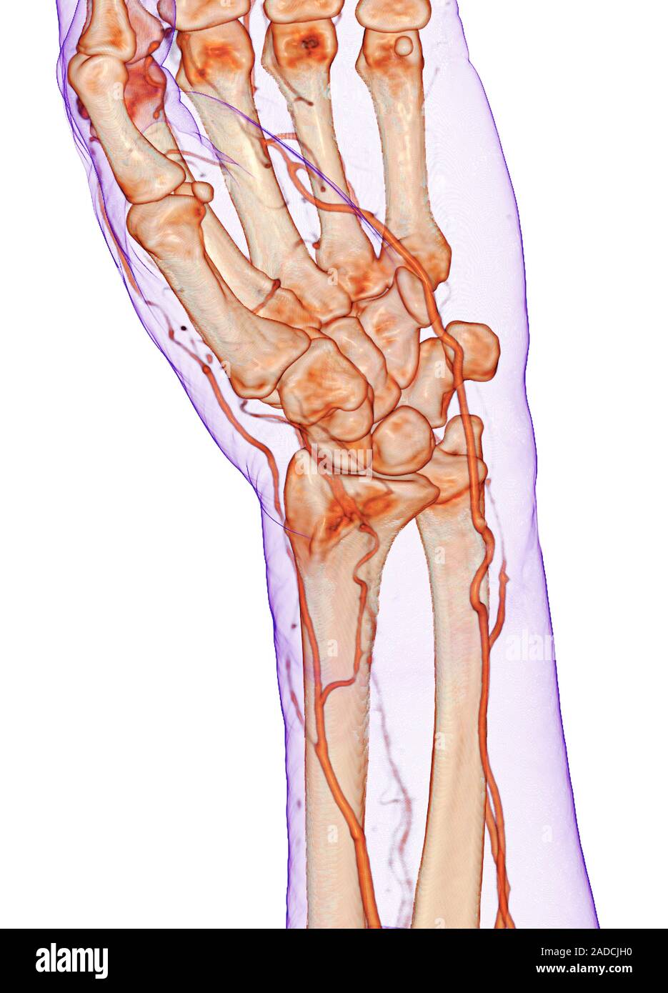 Wrist blood vessels. Coloured 3D computed tomography (CT) angiogram of ...