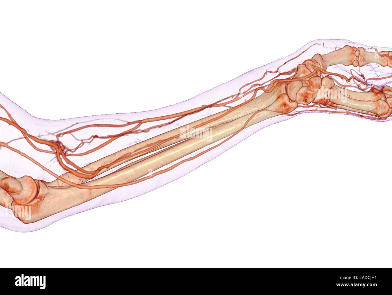 Forearm blood vessels. Coloured 3D computed tomography (CT) angiogram ...