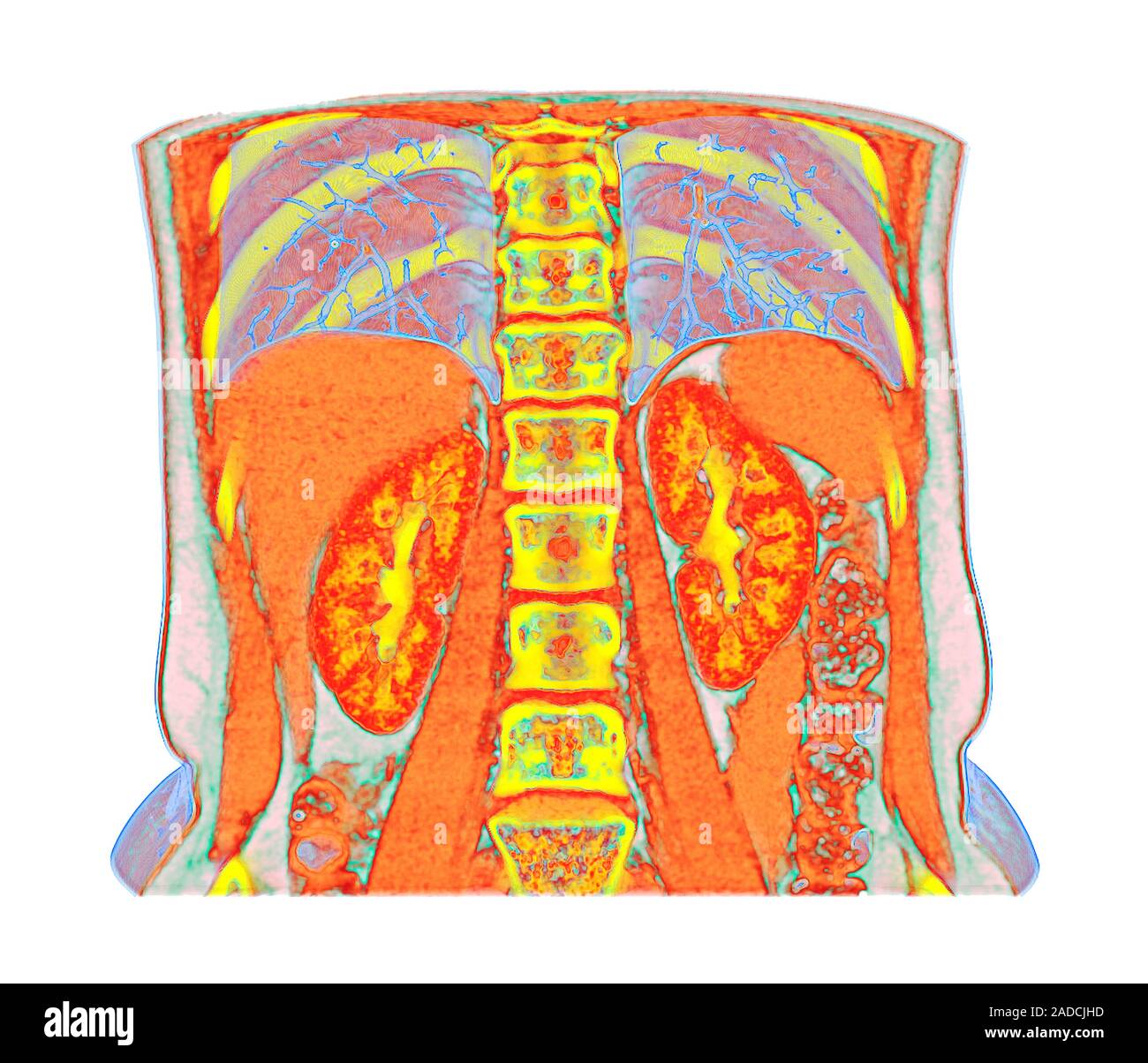 Abdominal organs. Coloured coronal computed tomography (CT) scan ...