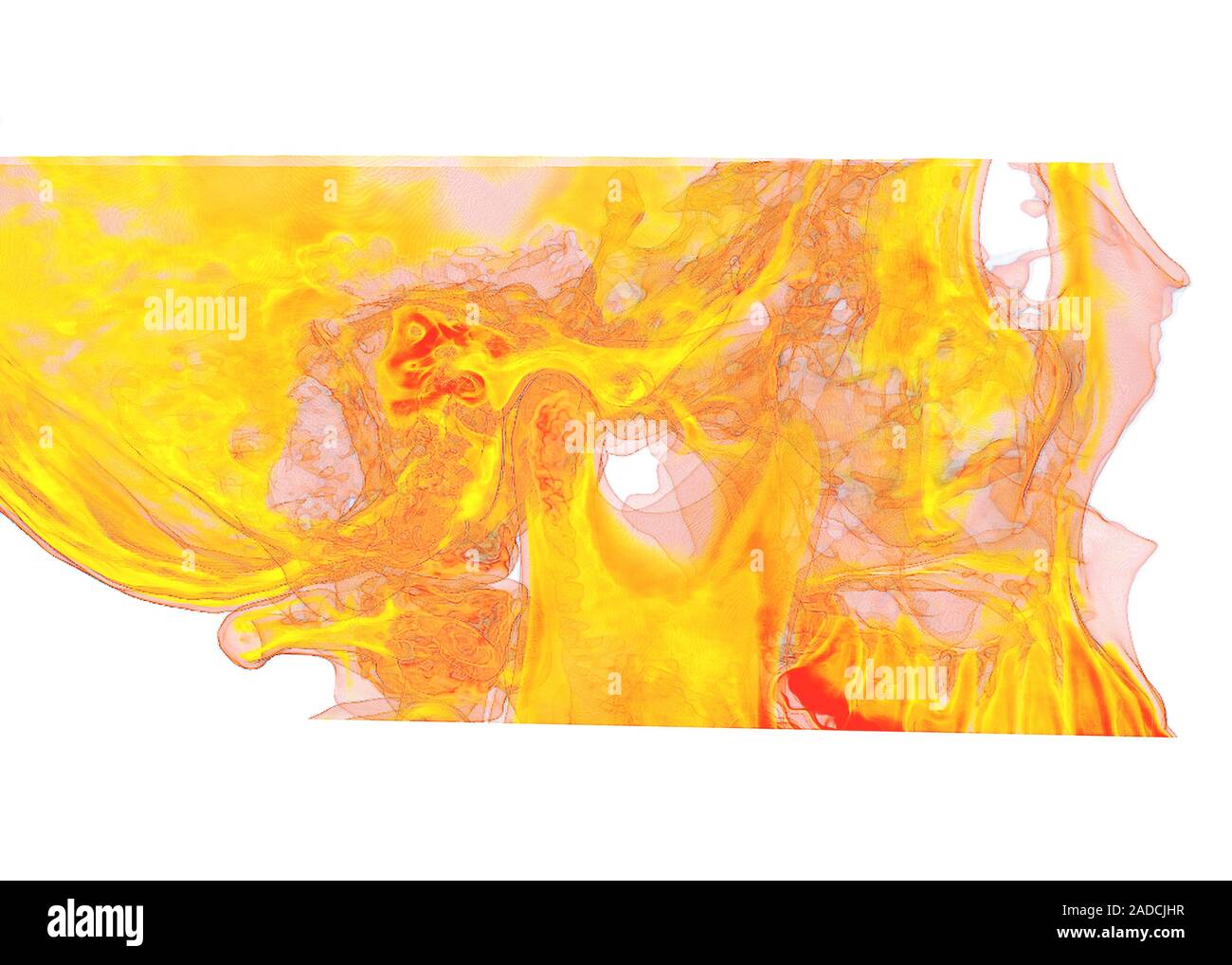Temporomandibular joint. Coloured lateral 3D computed tomography (CT ...