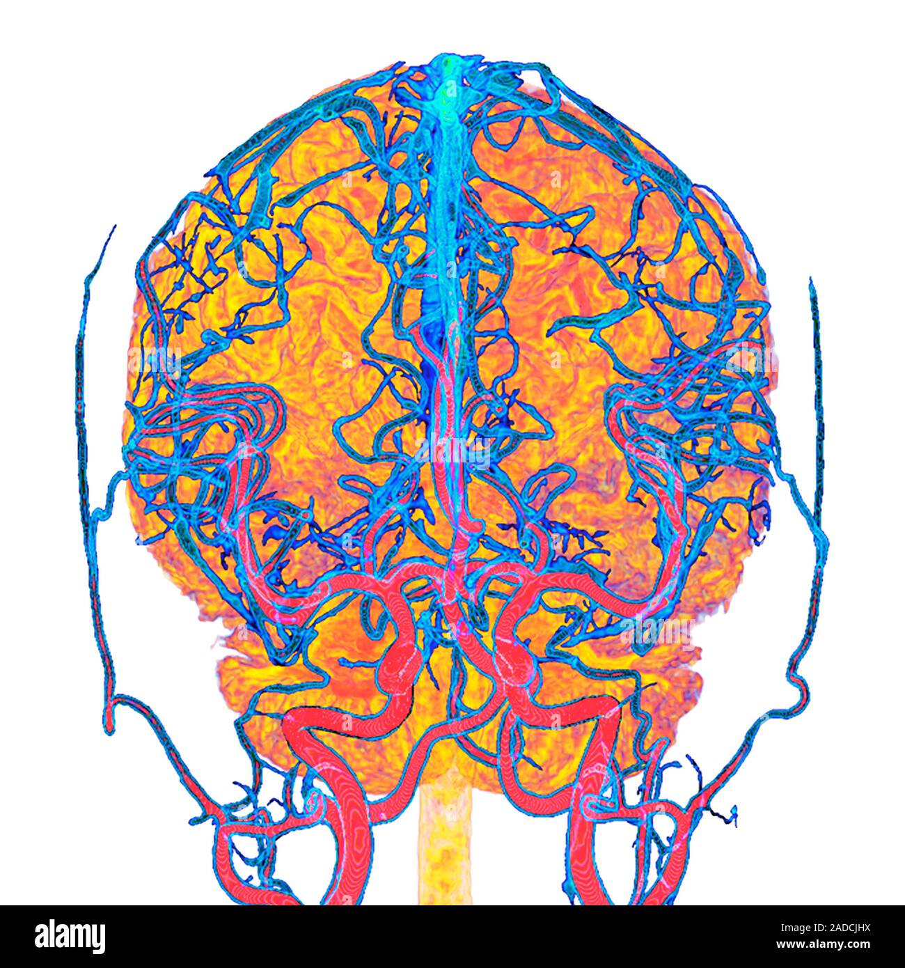 Brain blood vessels. Coloured frontal 3D magnetic resonance imaging (MRI) and computed ...
