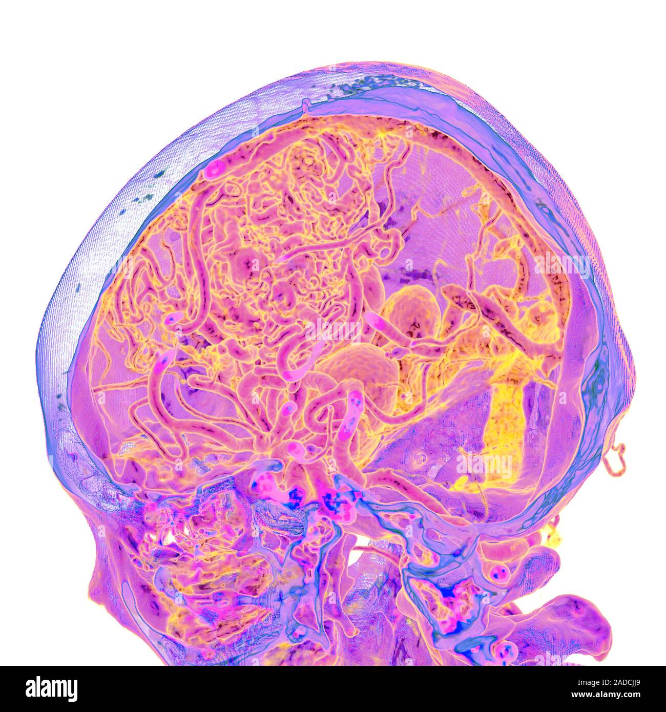 Cerebral arteriovenous malformation. Coloured 3D computed tomography (CT) angiogram scan of an ...