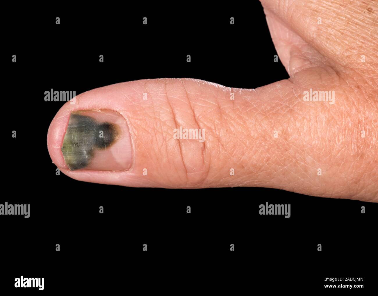 Pseudomonas bacterial nail infection. Close-up of the thumb on the ...