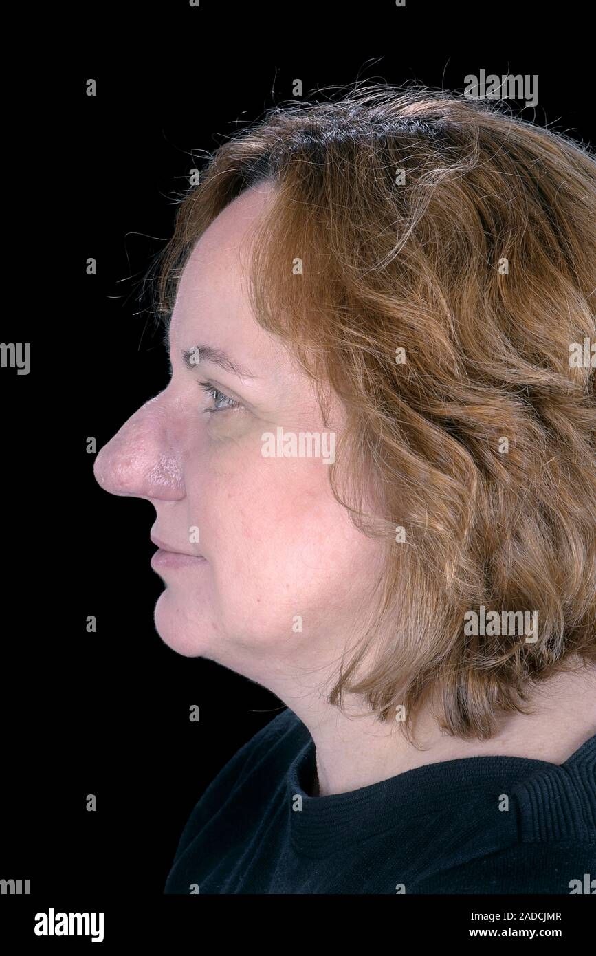 Rhinophyma. Lateral view of the head of a 51-year-old woman with the ...