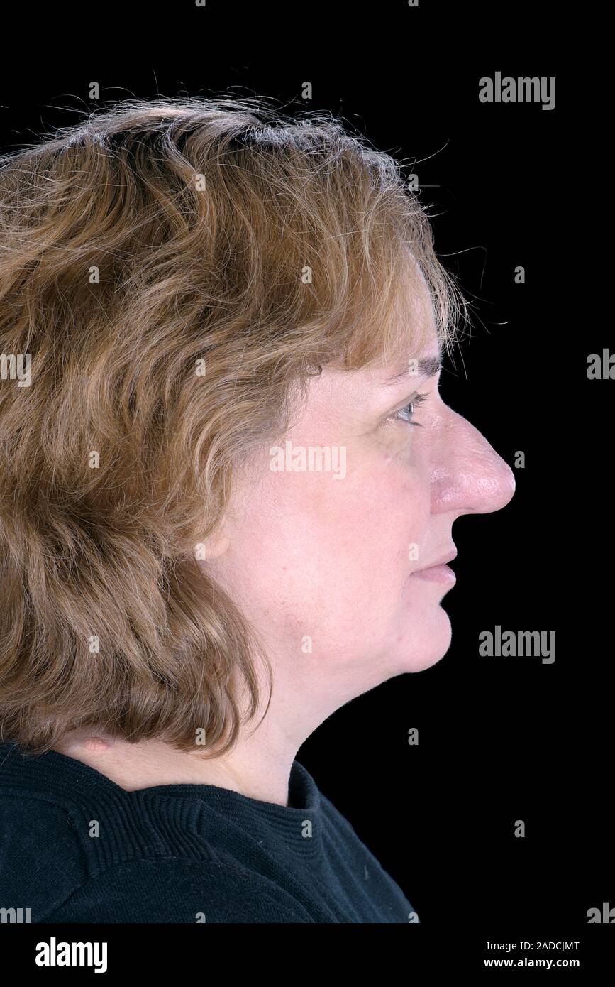 Rhinophyma. Lateral view of the head of a 51-year-old woman with the ...