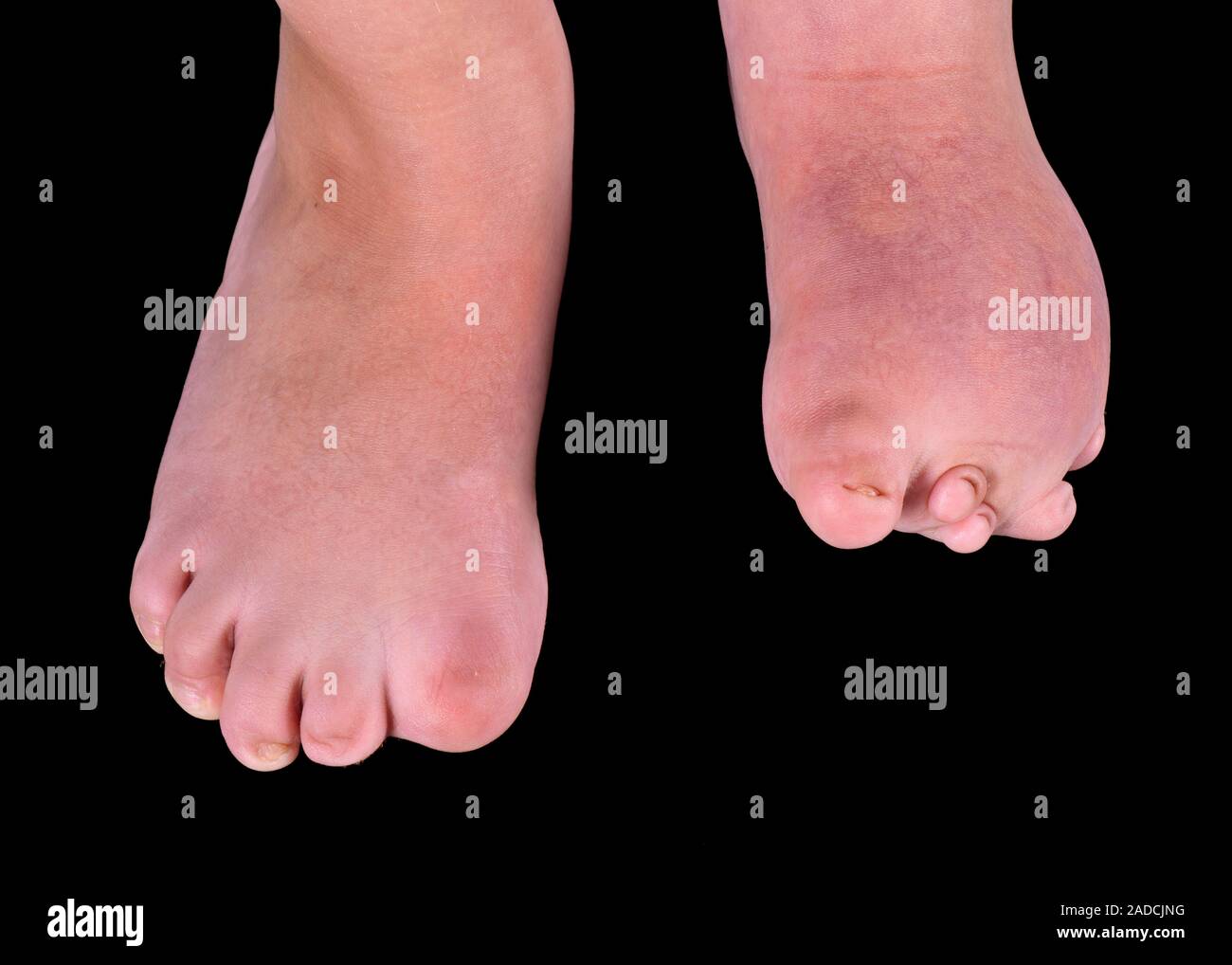 Amniotic band constriction deformities. Feet of a girl with missing and ...