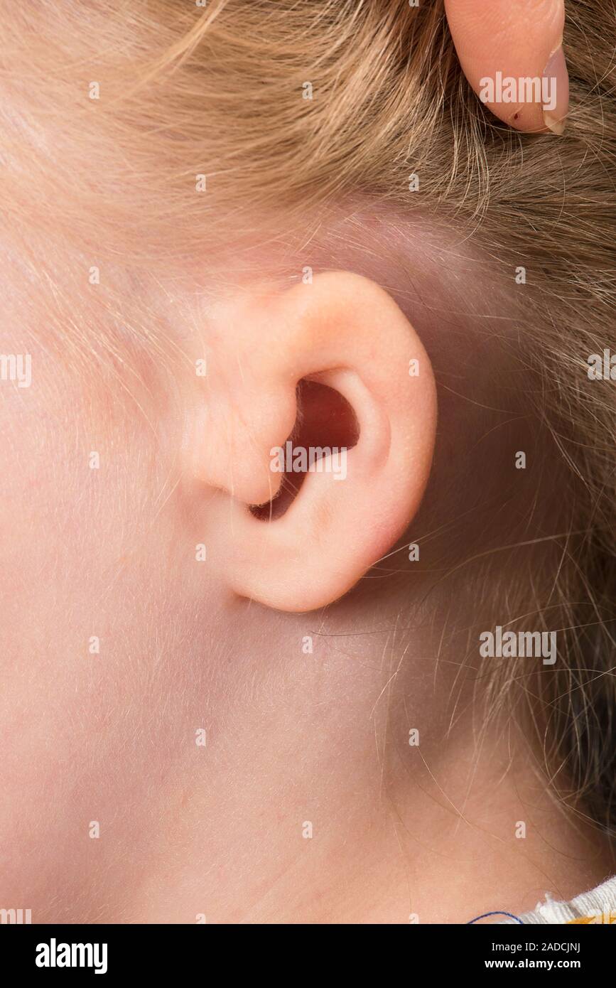Congenital ear abnormality. Congenital (from birth) deformity of the ...