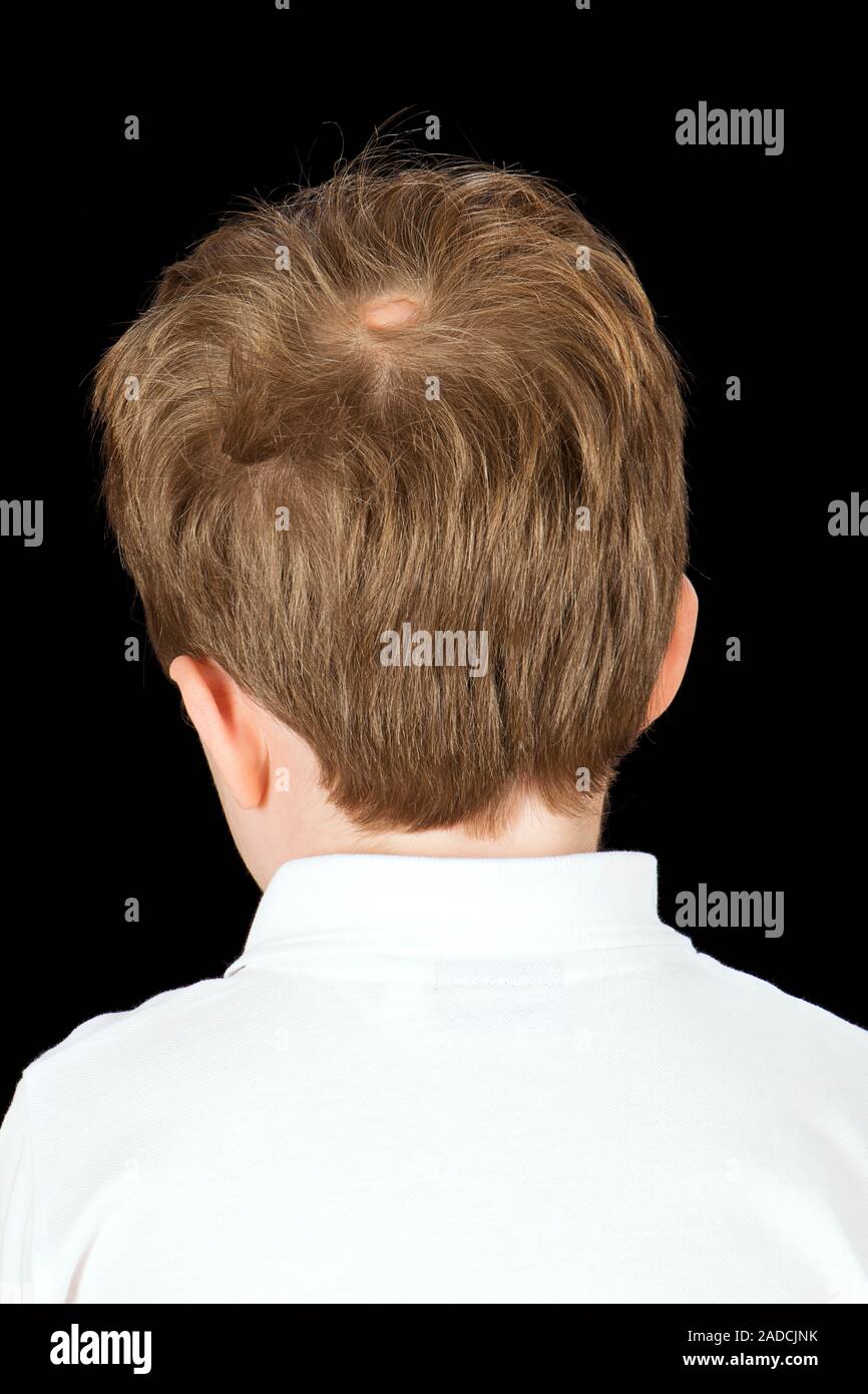 Aplasia cutis congenita. Rear view of the scalp of a 6-year-old boy ...