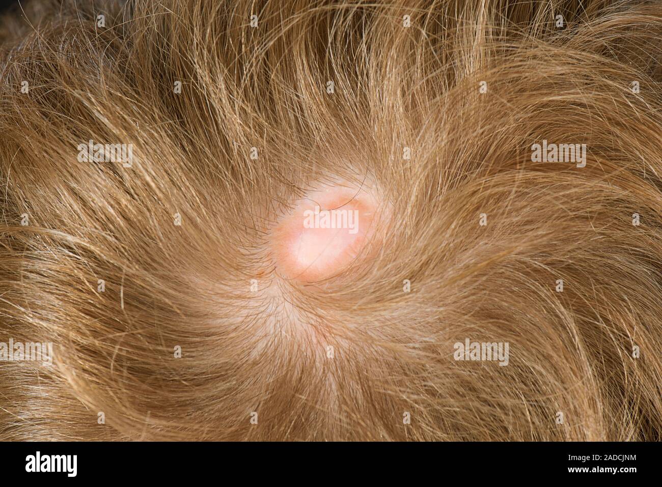Aplasia cutis congenita. Close-up of the scalp of a 6-year-old boy ...