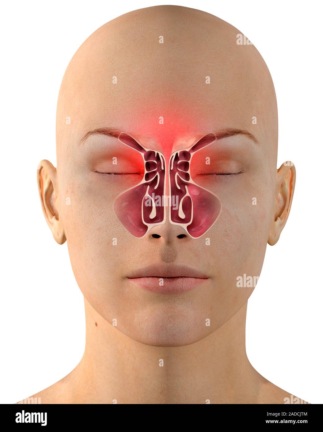 Sinus infection, or sinusitis, computer illustration. The sinuses are ...