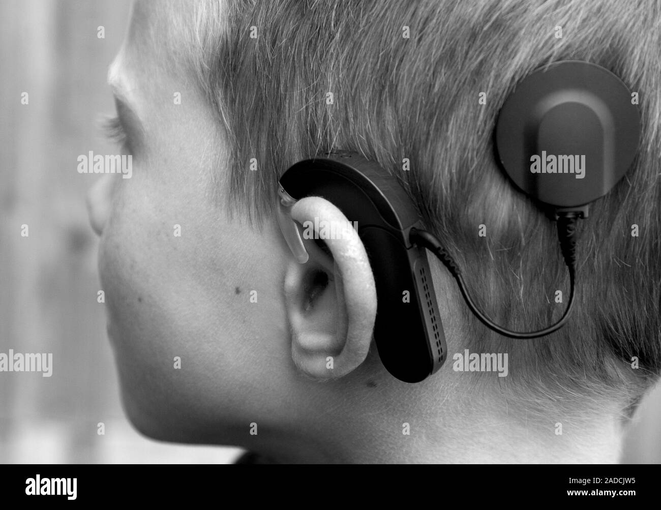 Boy fitted with cochlear implant. Cochlear implant being worn on the ...