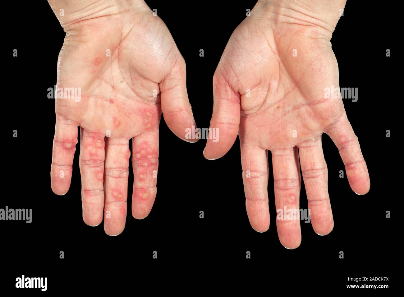Common warts (verruca vulgaris) on the hands of a 35 year old male ...