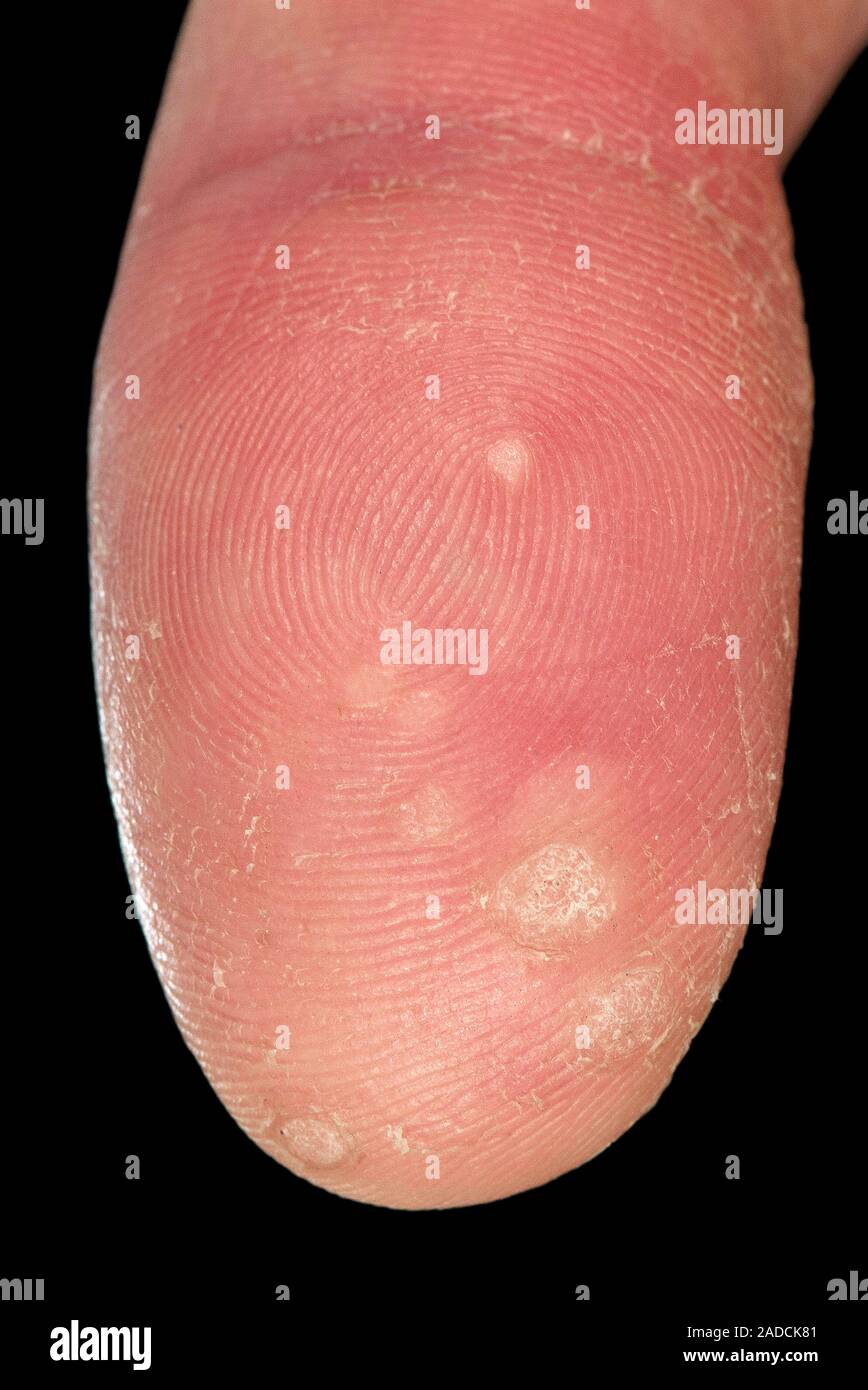 Common warts (verruca vulgaris) on the finger of a 35 year old male ...