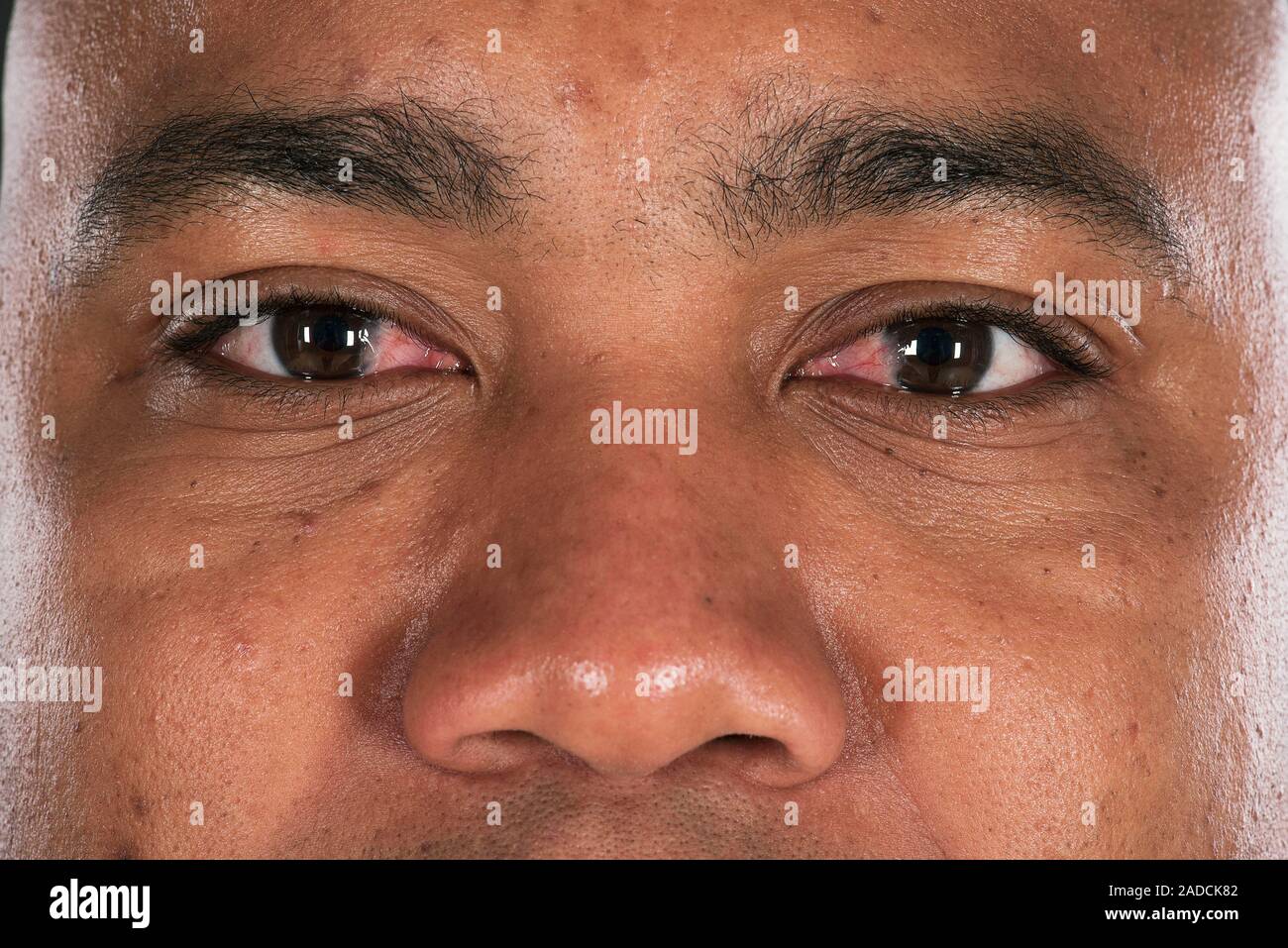 Pterygium growths in the corners of a 33 year old male patient's eyes ...