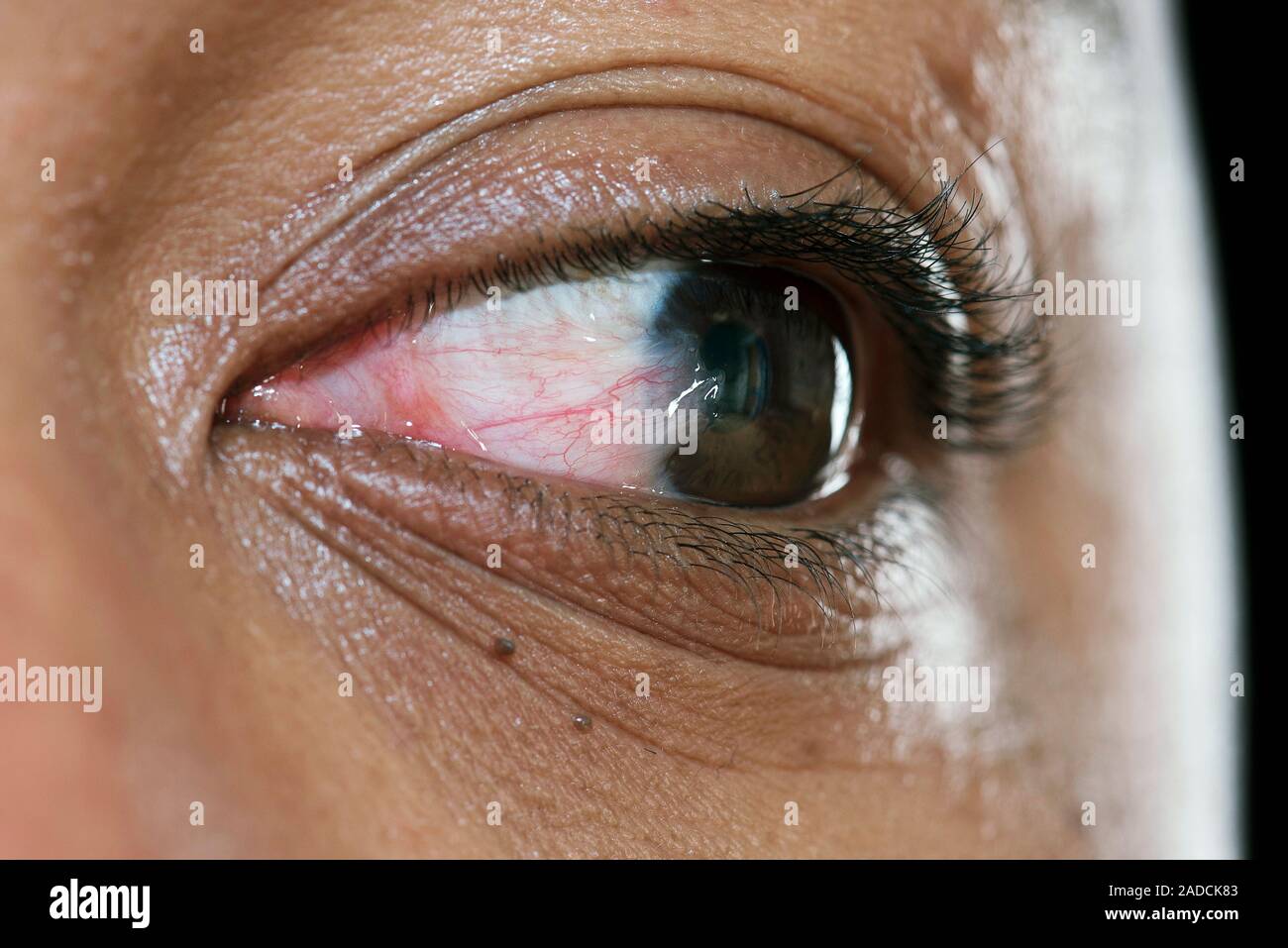 Pterygium growth in the corner of a 33 year old male patient's eye. A ...
