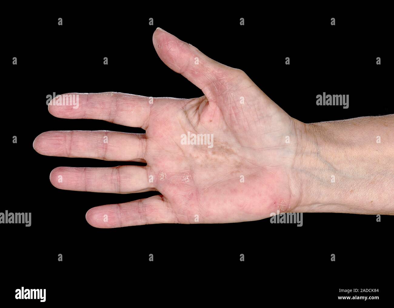 Psoriasiform dermatitis on the hand of a 66 year old female patient ...