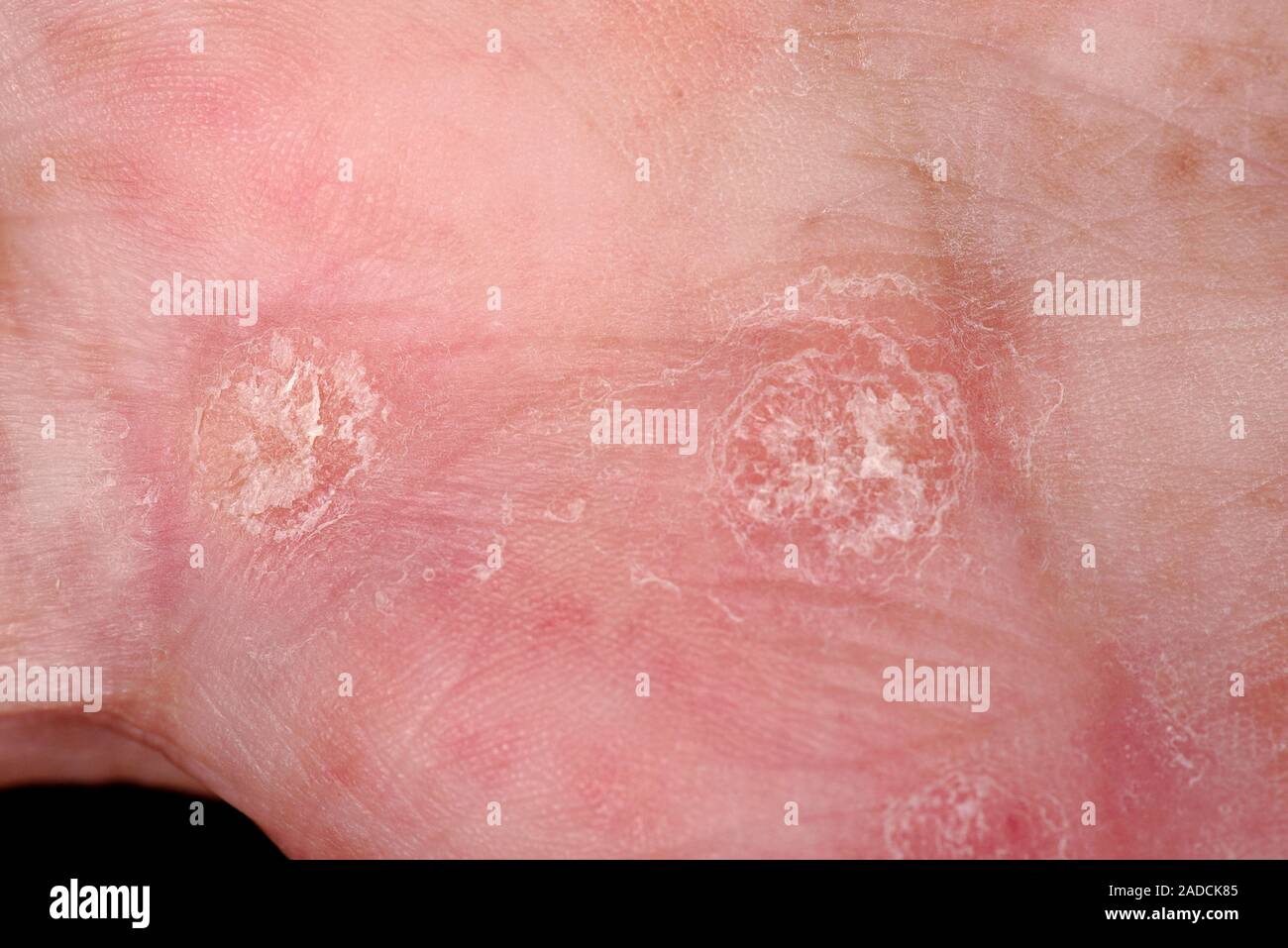 Close-up of psoriasiform dermatitis on the hand of a 66 year old female ...