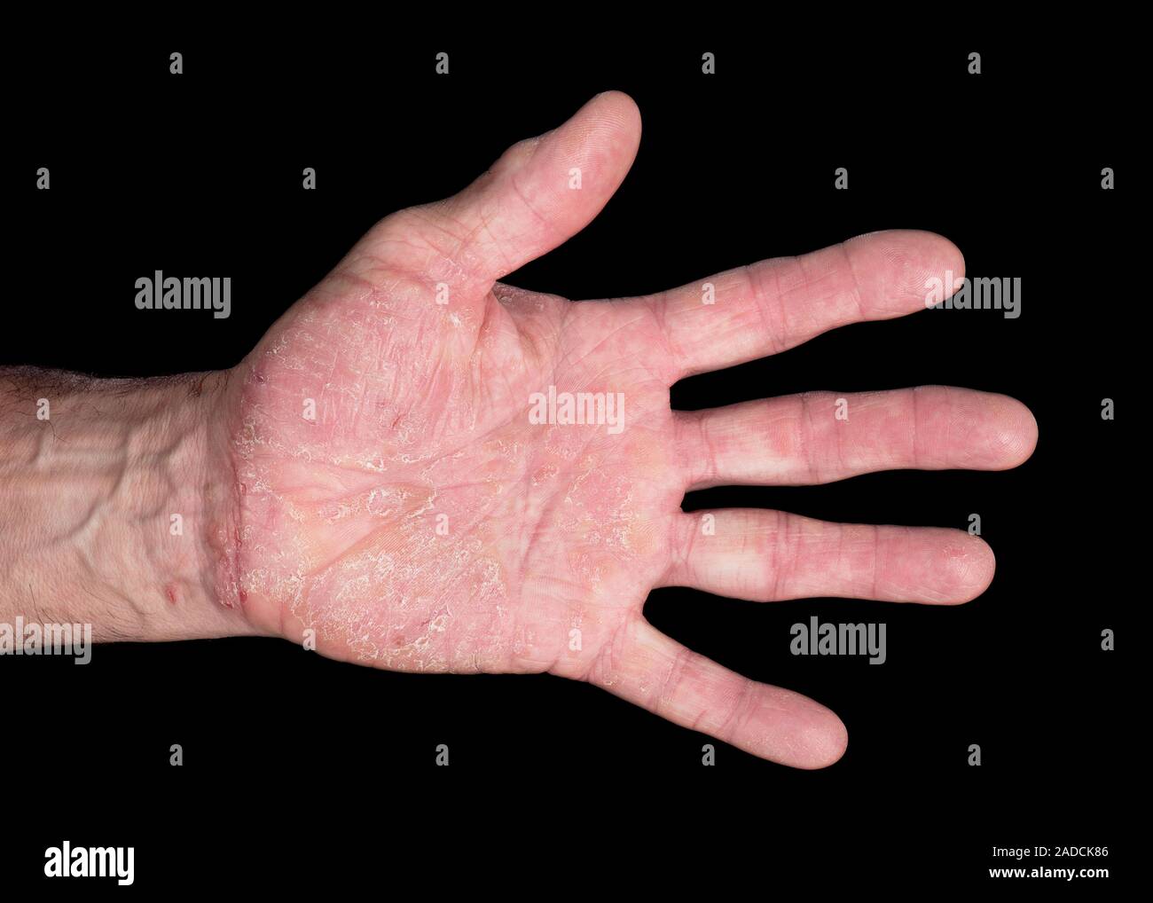Eczema on the hand of a 62 year old male patient. Eczema is an ...