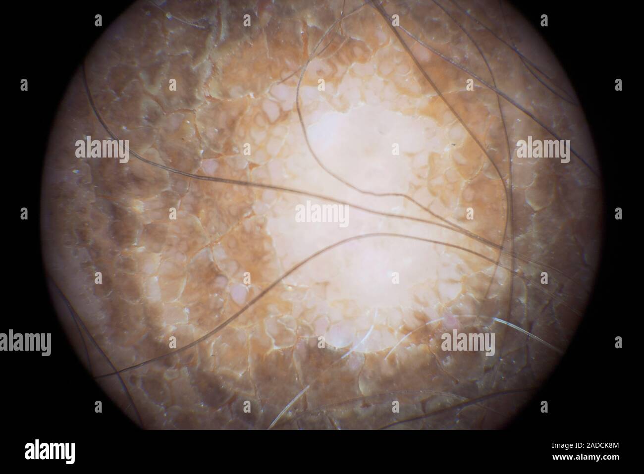 Dermatoscope image of a seborrheic keratosis on the chest of a 69 year ...