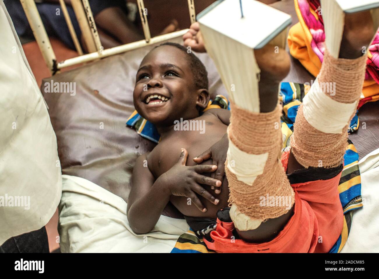 Child with legs under traction, lying in a hospital bed. The boy's legs ...