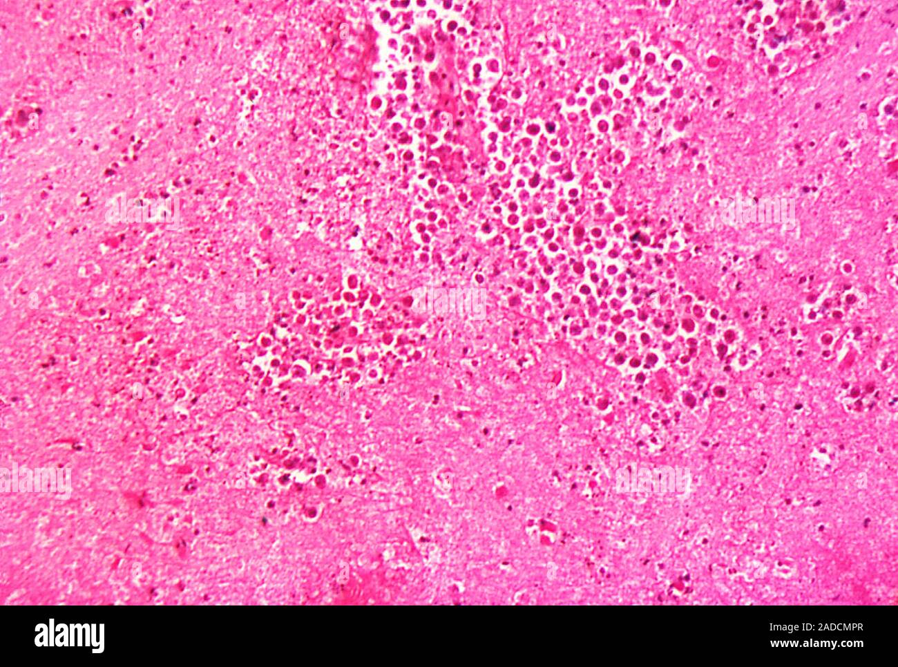 Naegleria fowleri amoeba infection. Light micrograph of a brain tissue ...