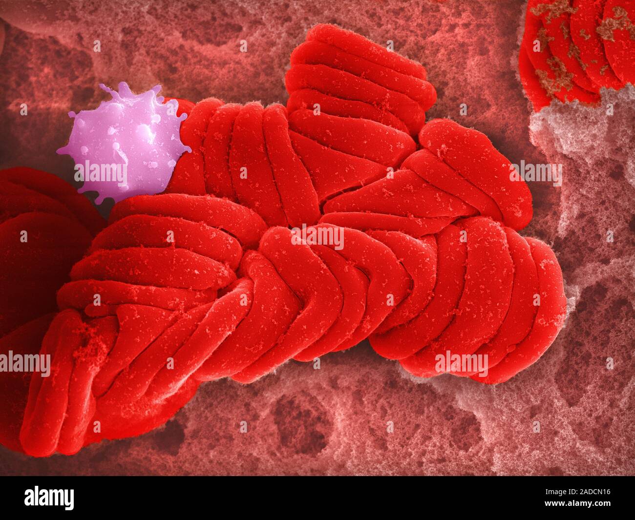 Blood clot. Coloured scanning electron micrograph (SEM) of red blood ...