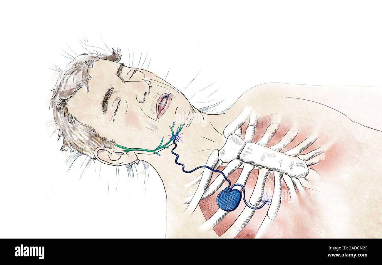Illustration of a pacemaker-like device implanted in the chest of a man ...