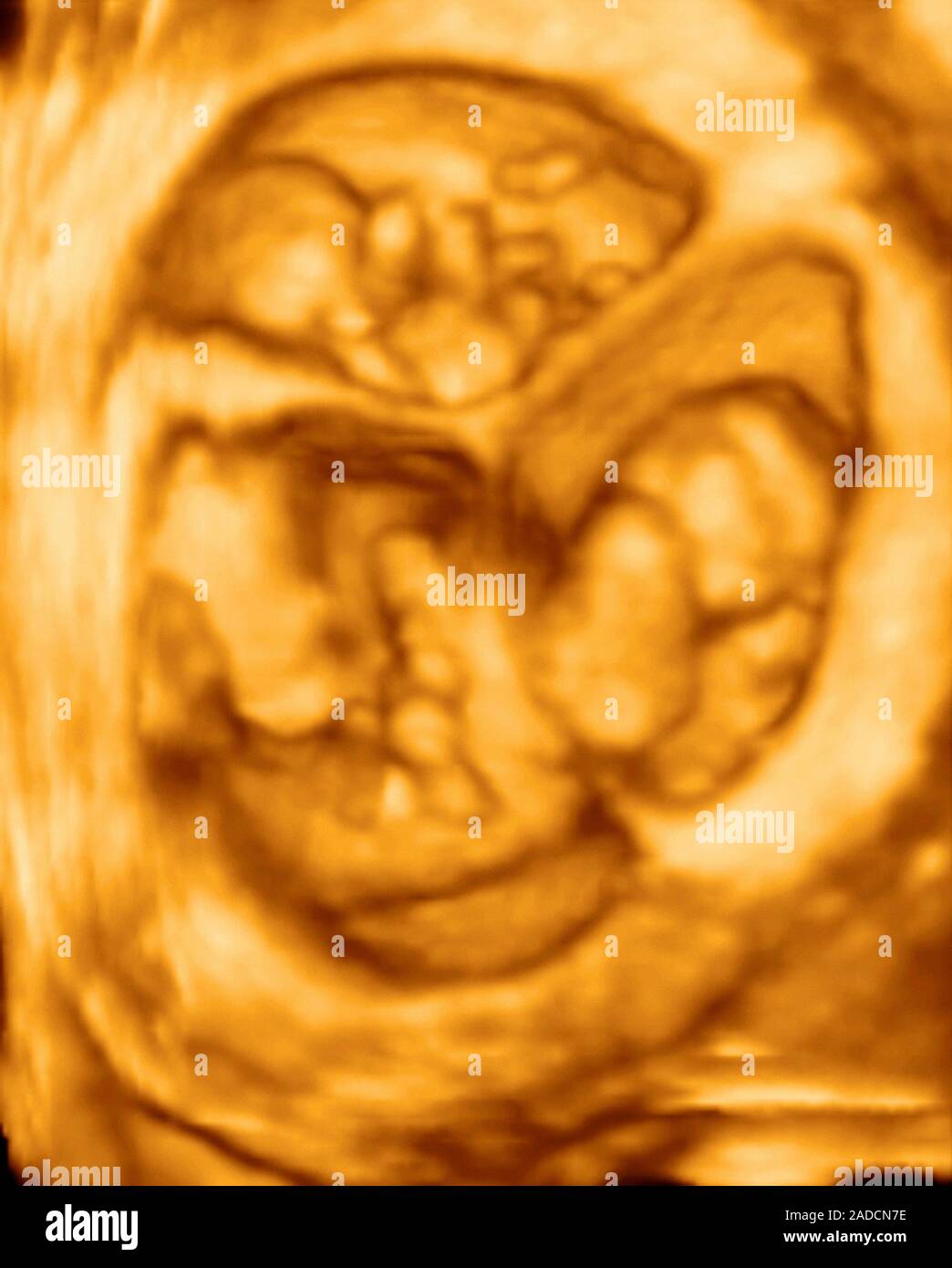 3D ultrasound scan of triplet foetuses at 11 weeks. Non-identical ...