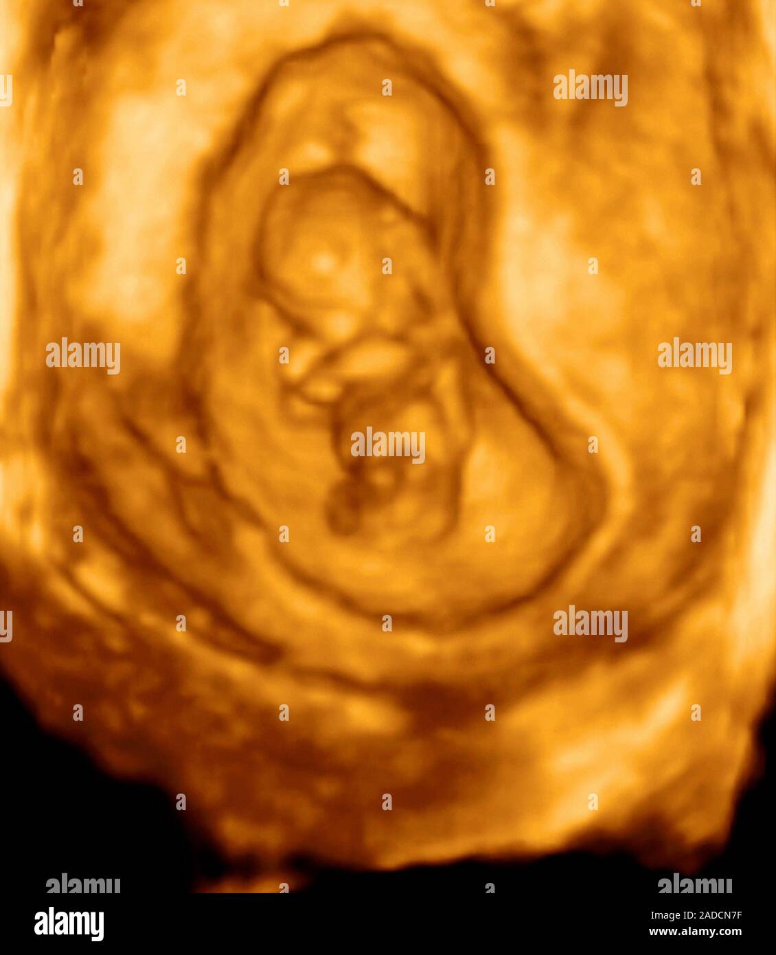 3D ultrasound scan of a foetus at 11 weeks. At this stage the head ...