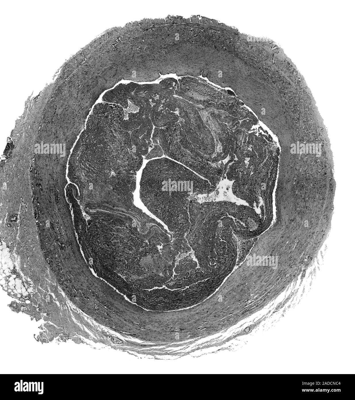 Arterial thrombosis. Light micrograph (LM) of a section through a ...