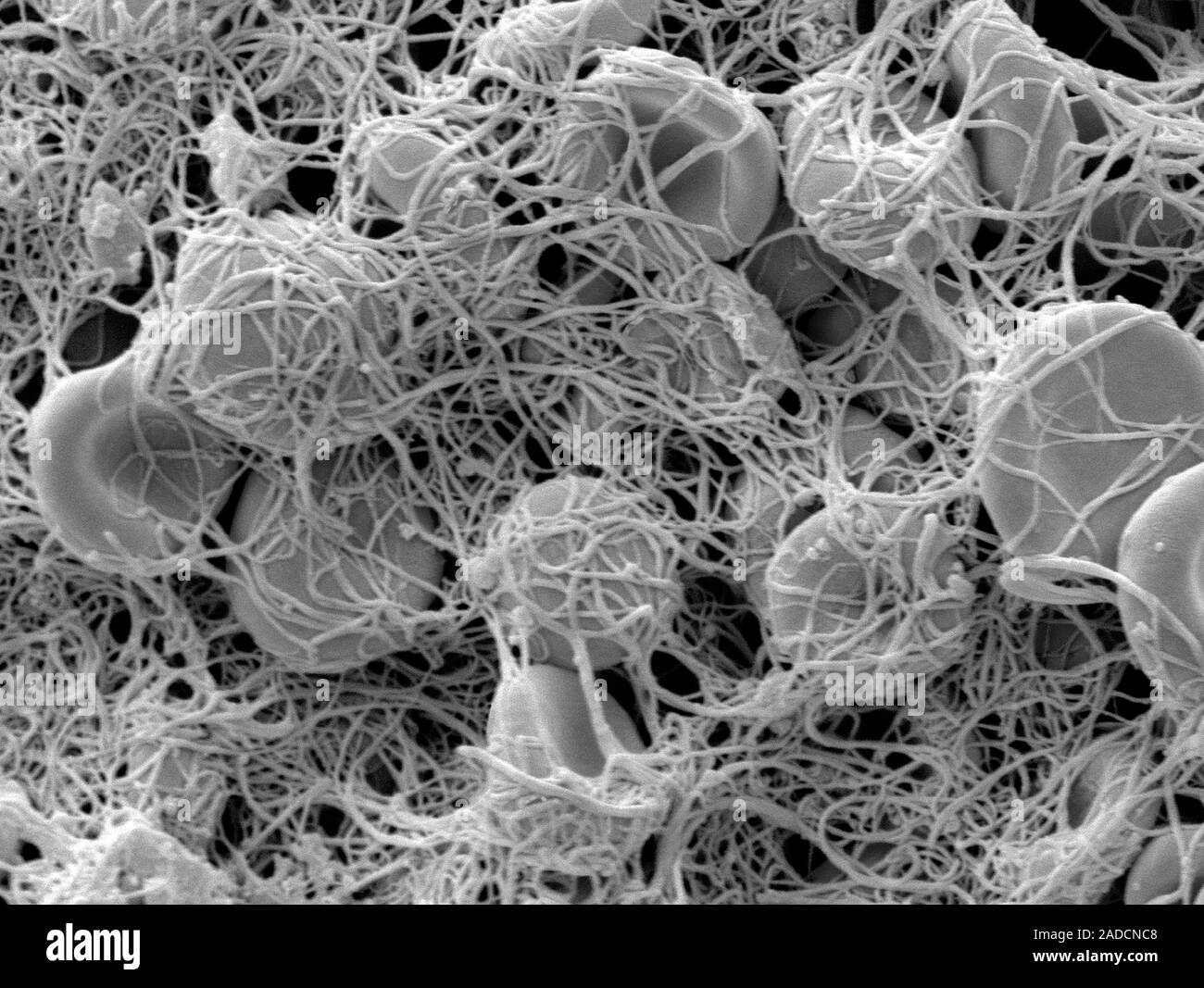 Blood clot, scanning electron micrograph (SEM). Red blood cells ...