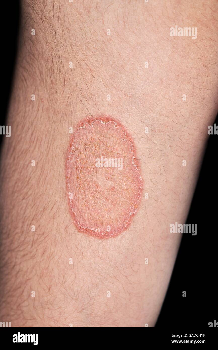 Ringworm infection on a teenage boy's arm. Ringworm is a disease caused ...