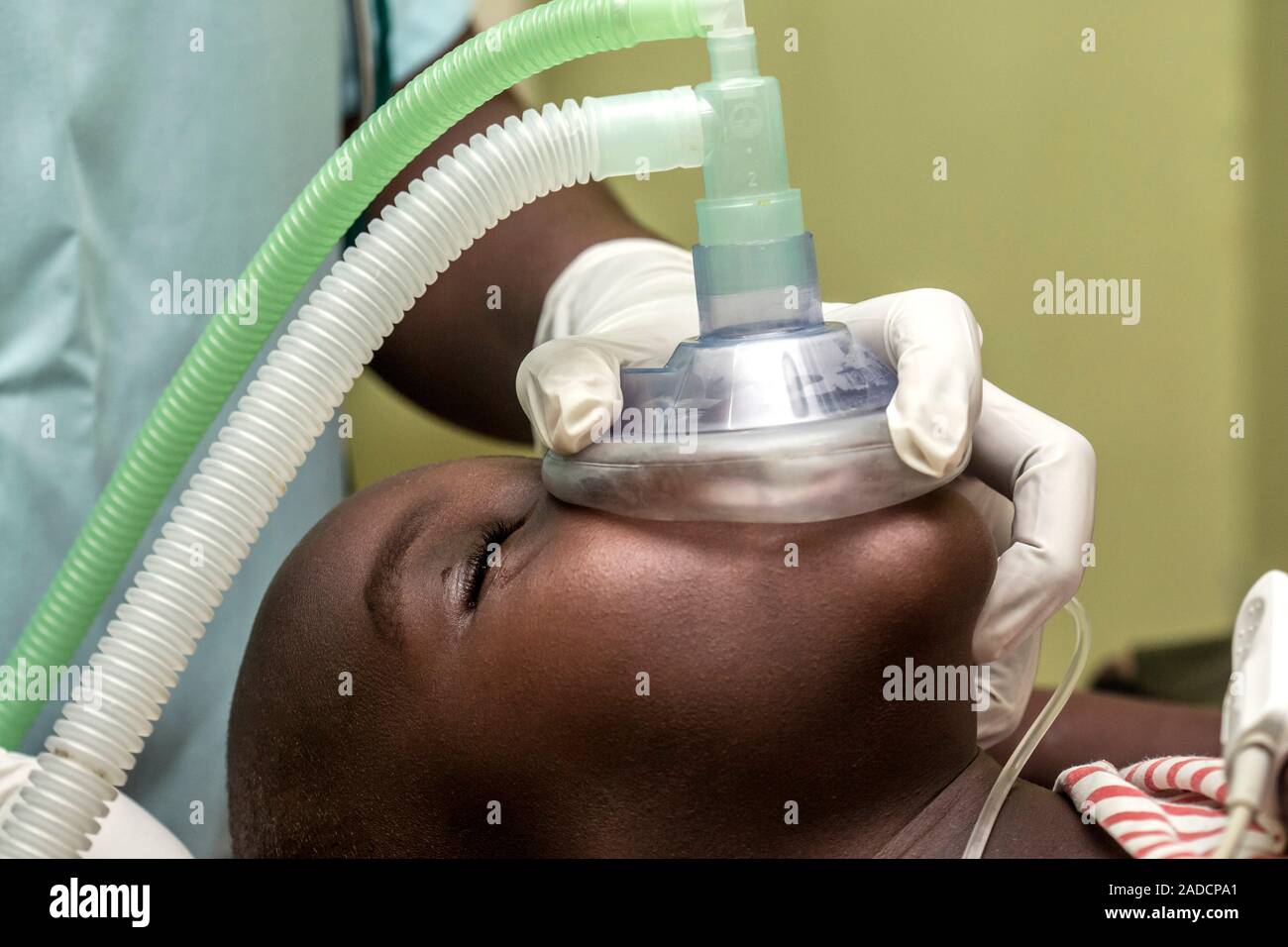 Anaethetised patient during surgery, with the anaesthetist ensuring the ...