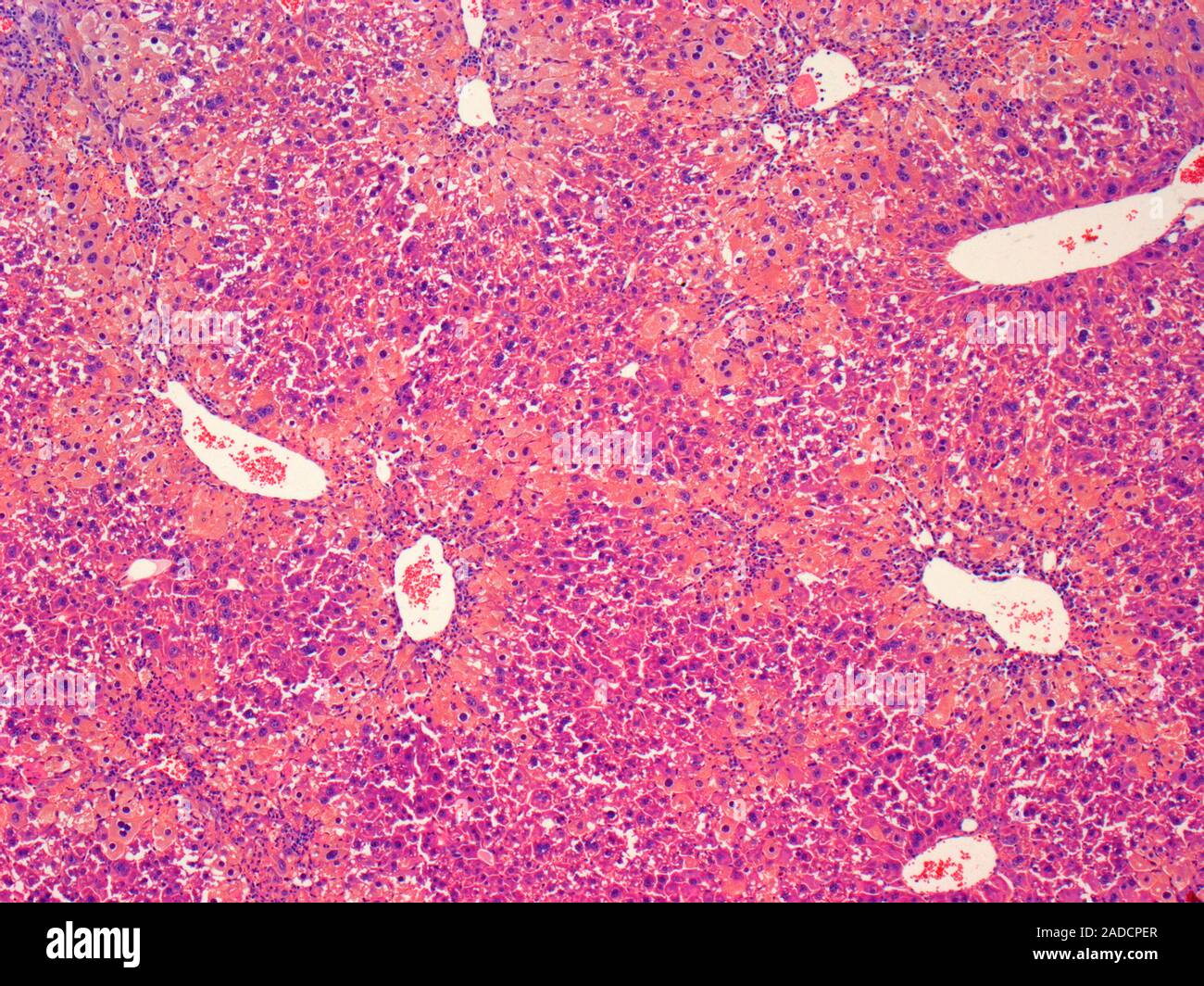 Viral hepatitis. Light micrograph (LM) of a section through a liver ...
