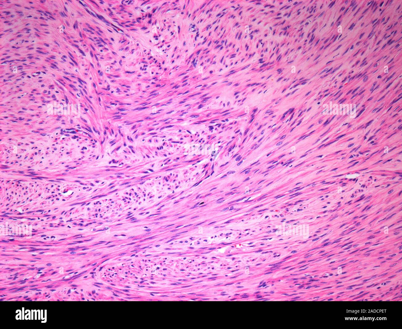 Uterine fibroid. Light micrograph (LM) of a section through tissue from ...