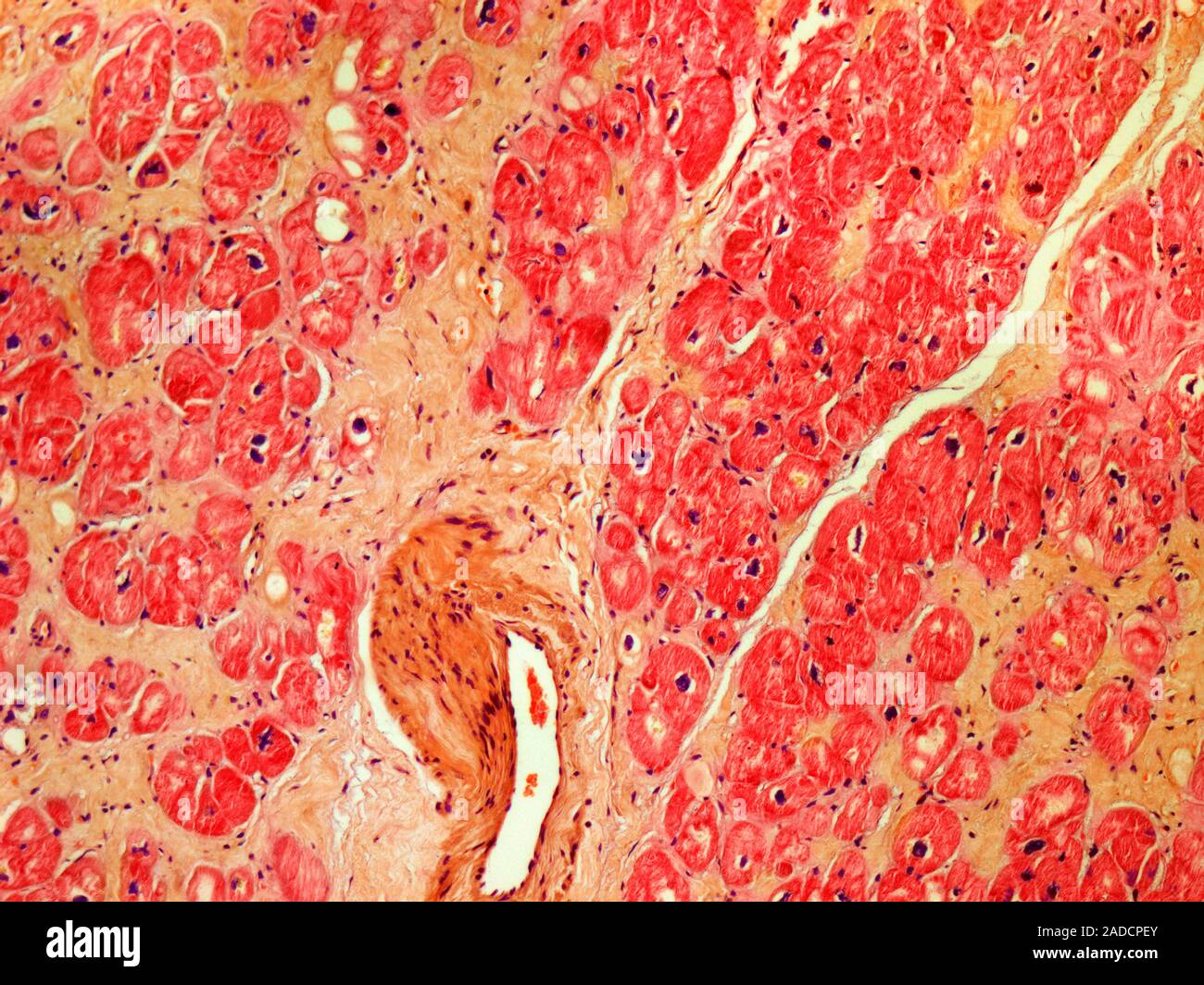 Heart tissue death. Light micrograph (LM) of infarcted (dead) human ...