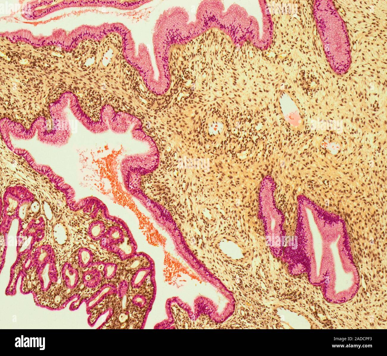 Nasal polyp. Light micrograph (LM) of a section through a nasal polyp ...