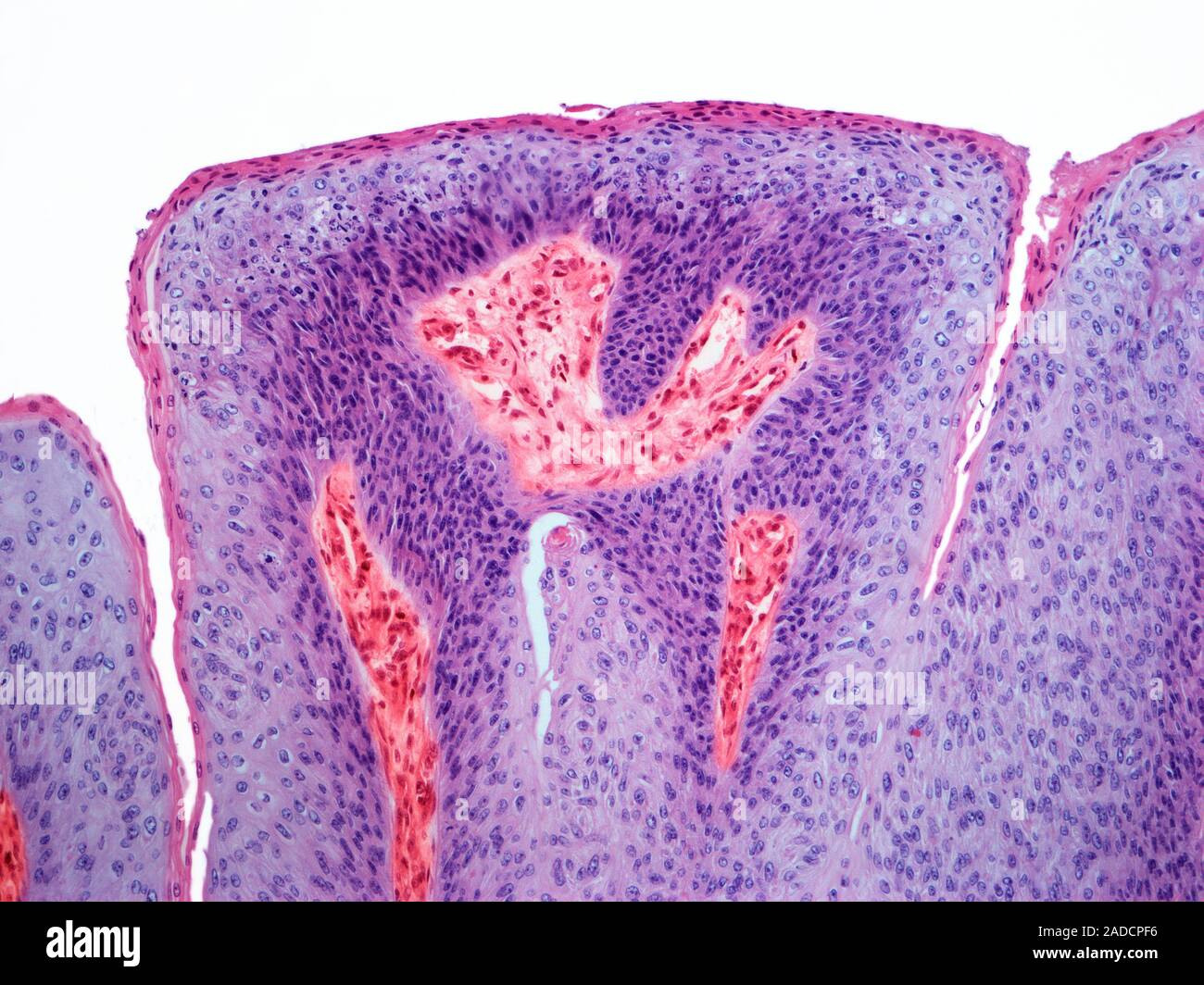 Genital wart. Light micrograph (LM) of a section through a genital wart ...