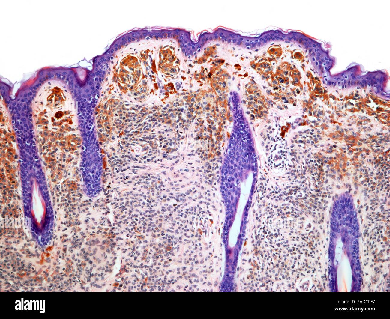 Skin mole. Light micrograph (LM) of a section through a naevus, a type ...