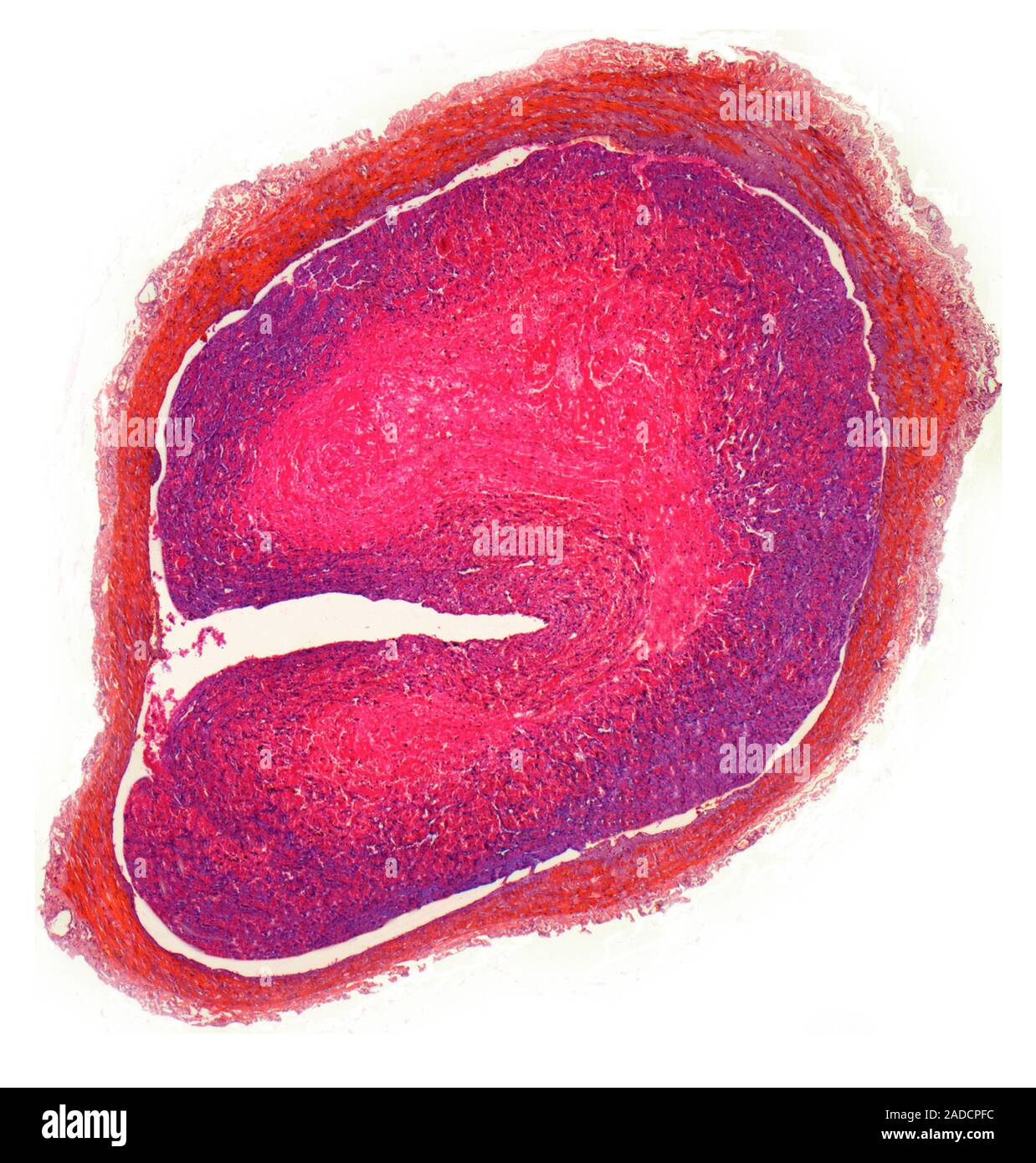 Deep vein thrombosis. Light micrograph (LM) showing a blood clot ...