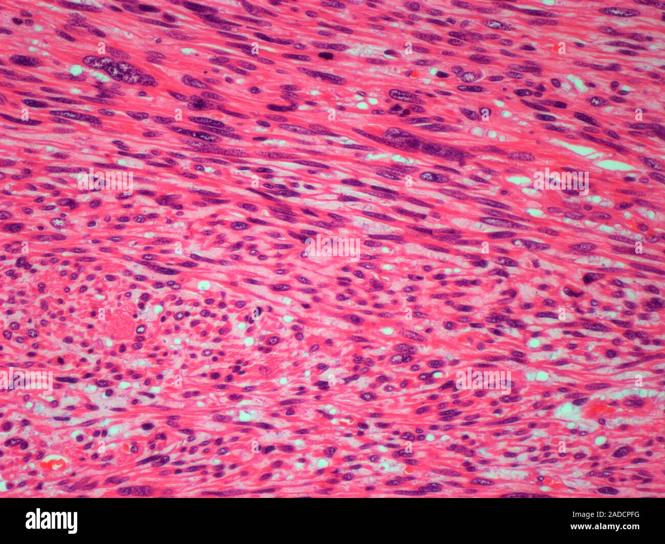 Leiomyosarcoma. Light micrograph (LM) of a leiomyosarcoma a malignant ...