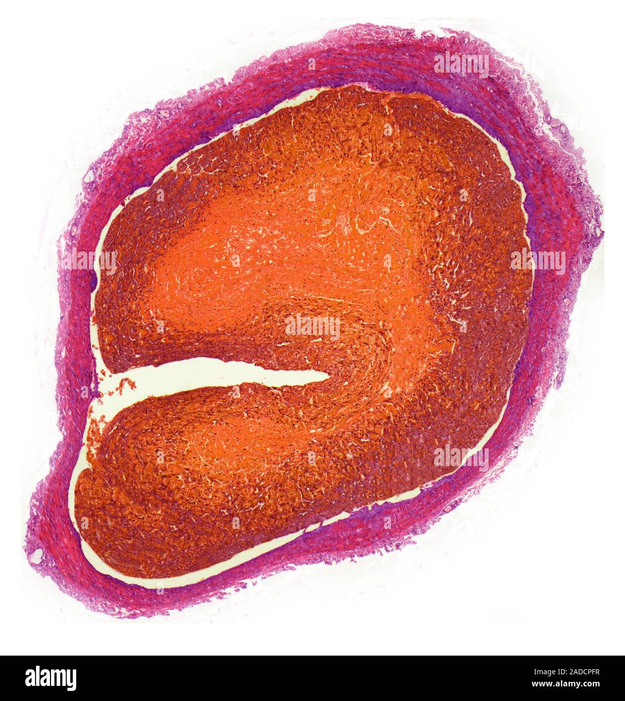 Deep vein thrombosis. Light micrograph (LM) showing a blood clot ...