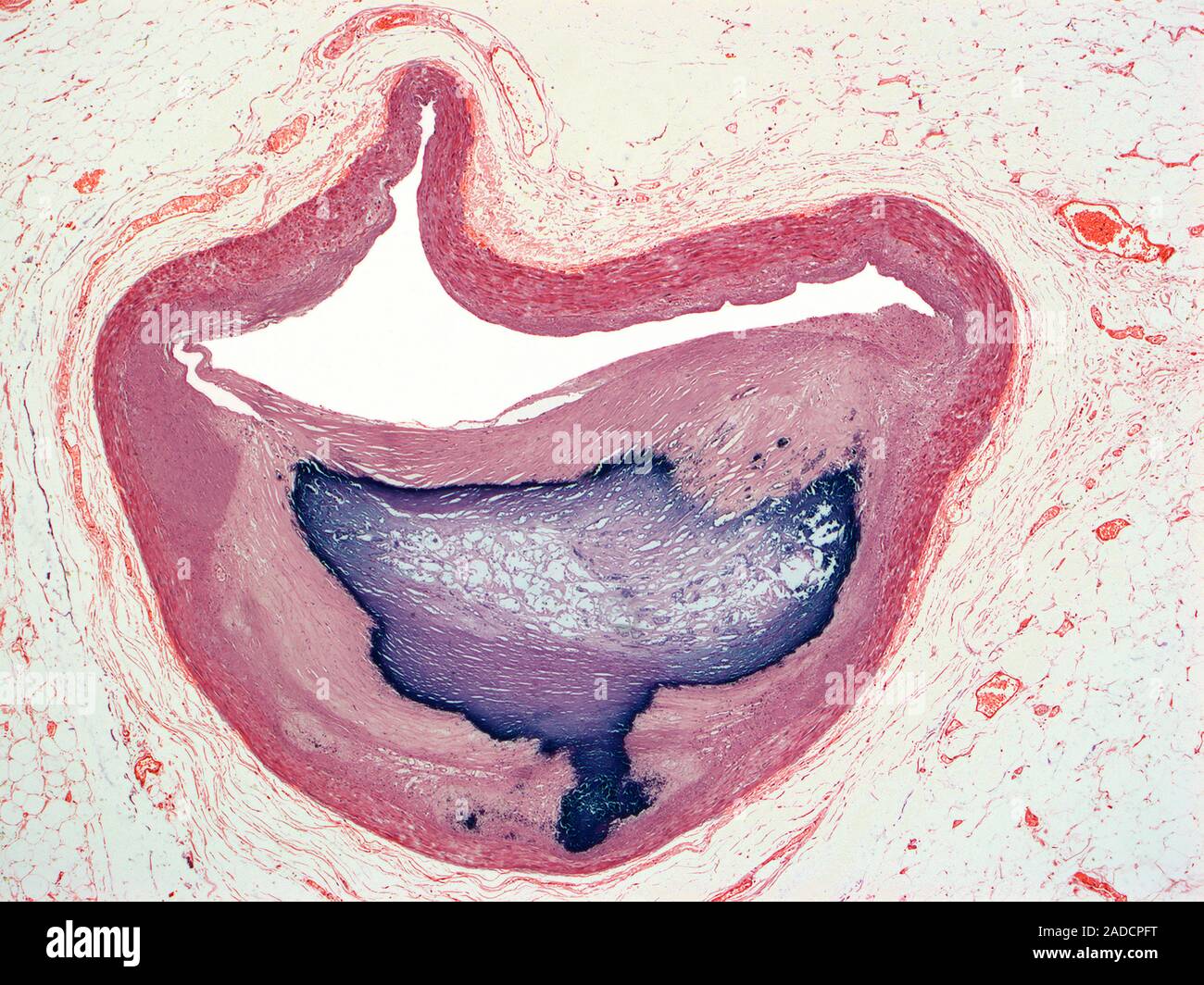 Atherosclerosis. Light micrograph (LM) of a section through an artery ...